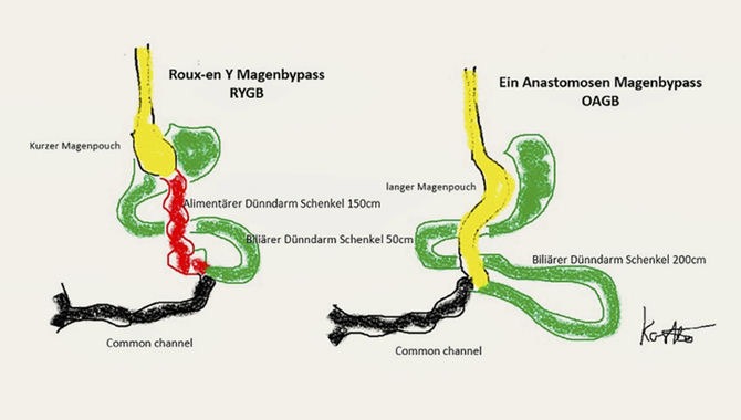 Der proximale Y-Magenbypass (Teil 2) - Adipositaszentrum Limmattal